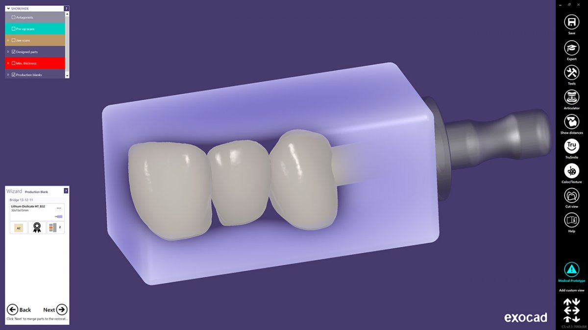 Exocad DentalCAD 2.3 Refresh Program