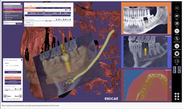 ABO exoplan Core Version - Innovative, intuitive, integrated exocad